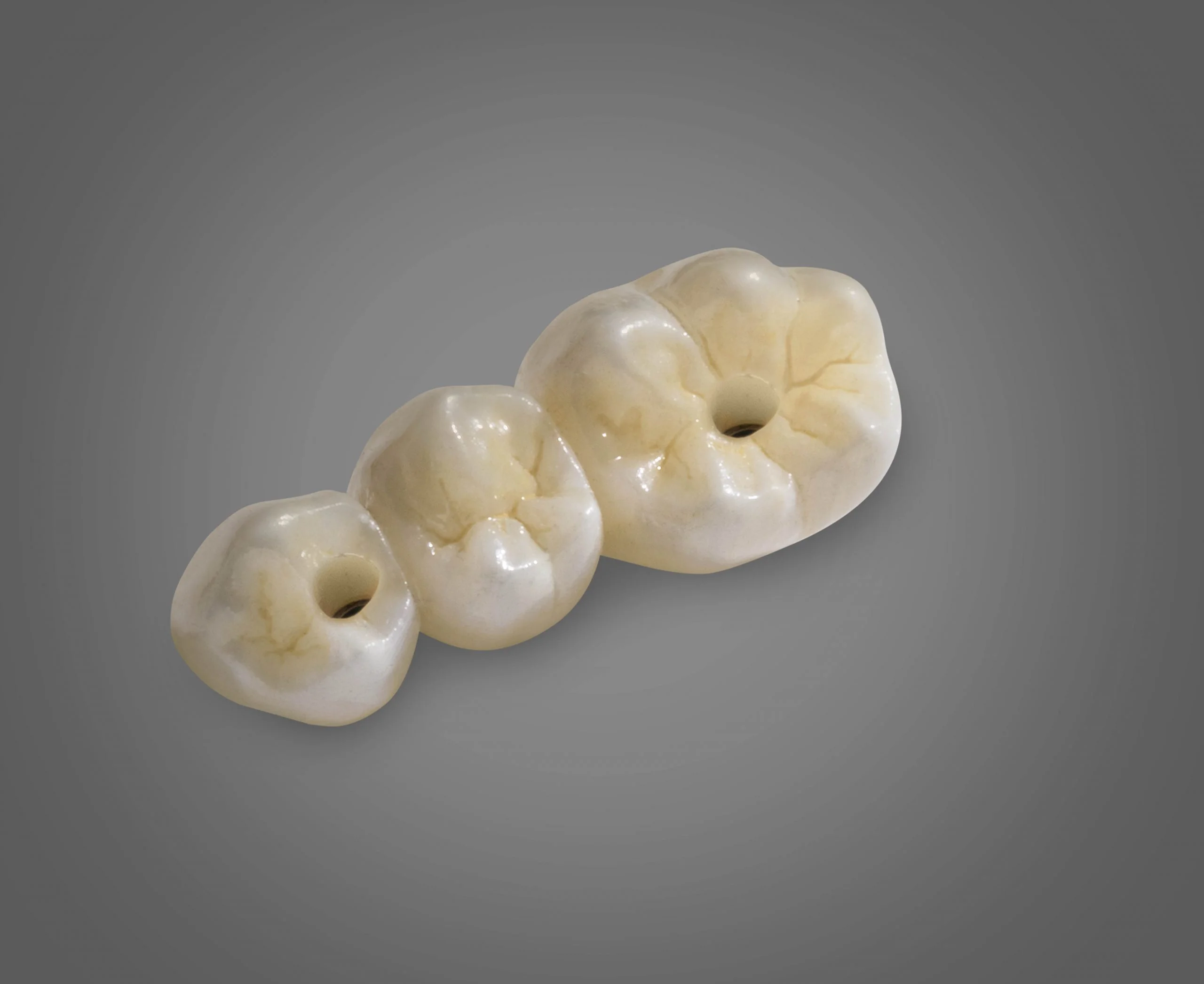 Prótese parcial fixa parafusada - Kion Dental