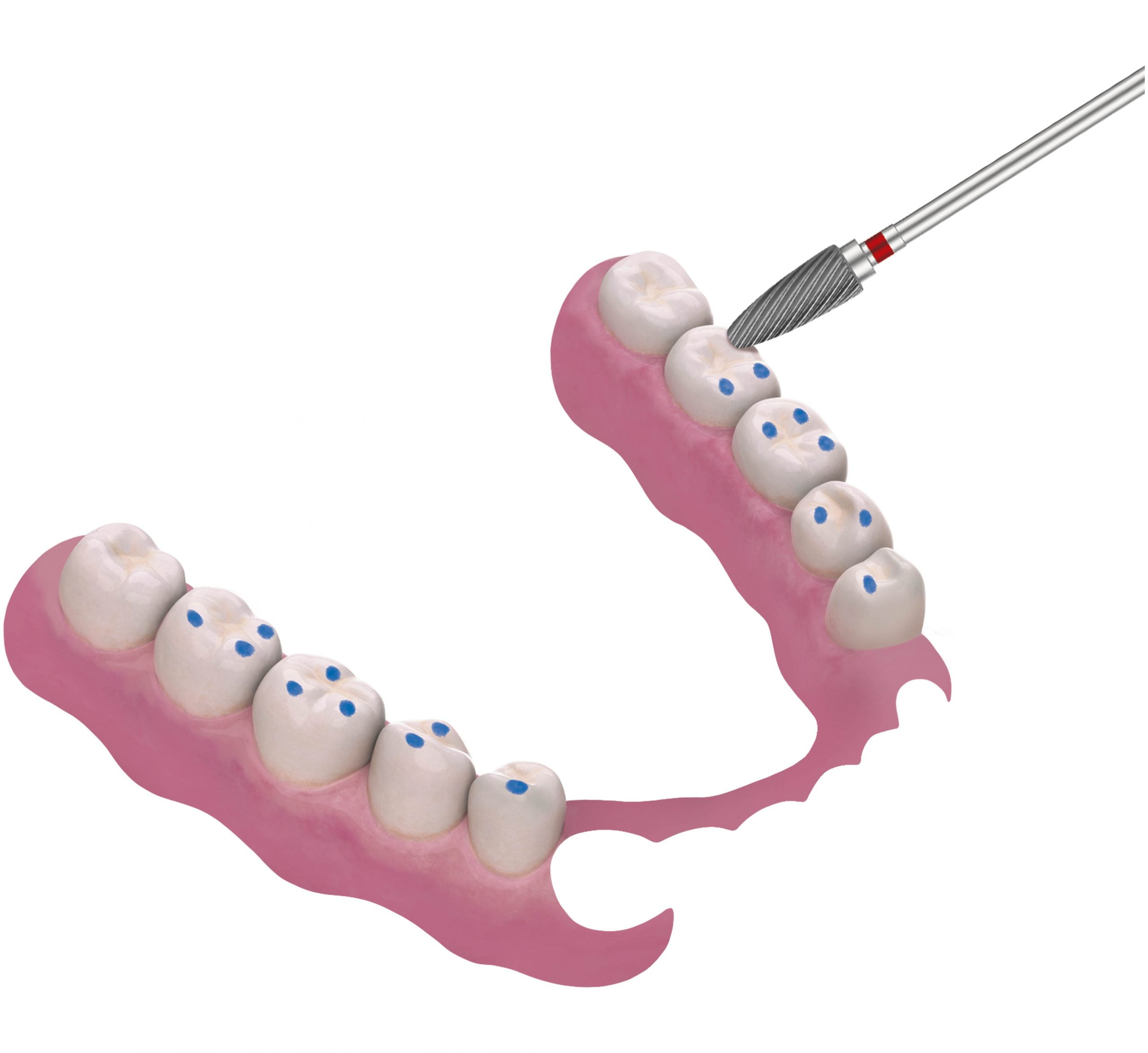 Prótese Flexível (Semirrígida Deflex) - Kion Dental