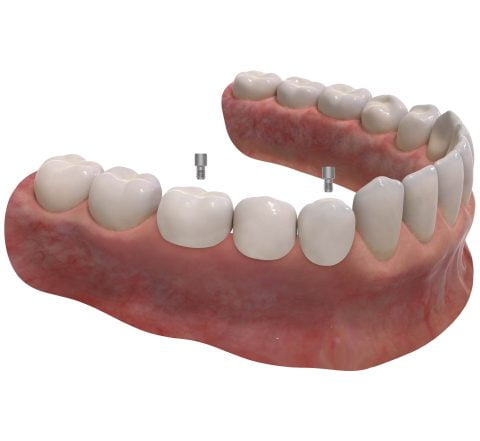 Prótese parcial fixa parafusada - Kion Dental
